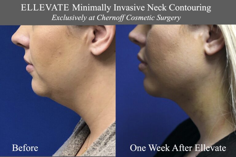 Ellevate Neck Contouring - Dr. Chernoff Plastic Surgery