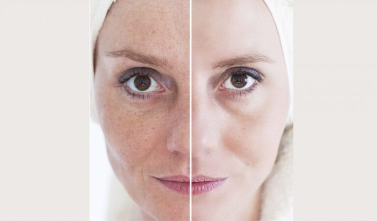 DOT Laser & LitePeel - Dr. Chernoff Plastic Surgery