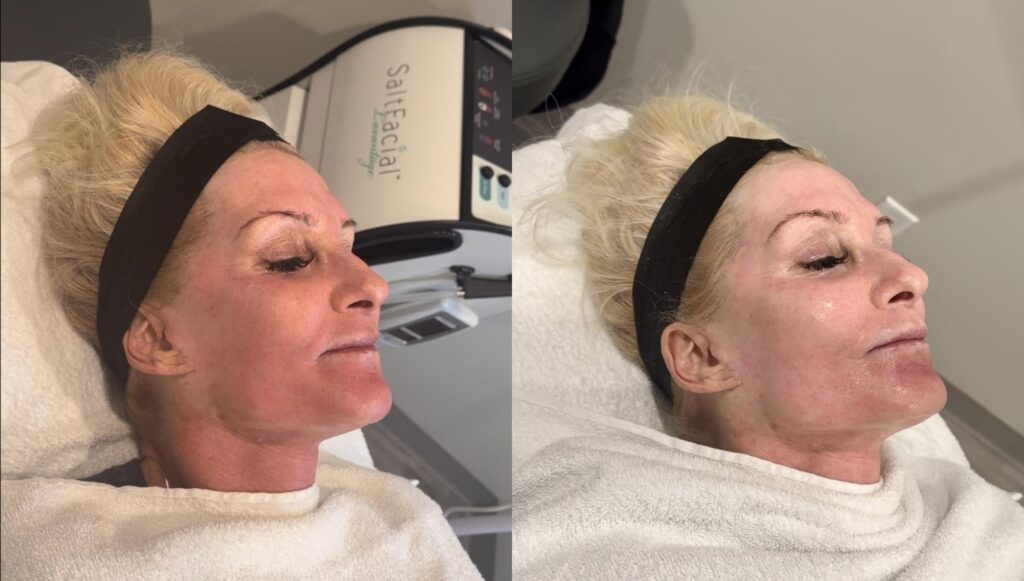 DOT Laser - Dr. Chernoff Plastic Surgery