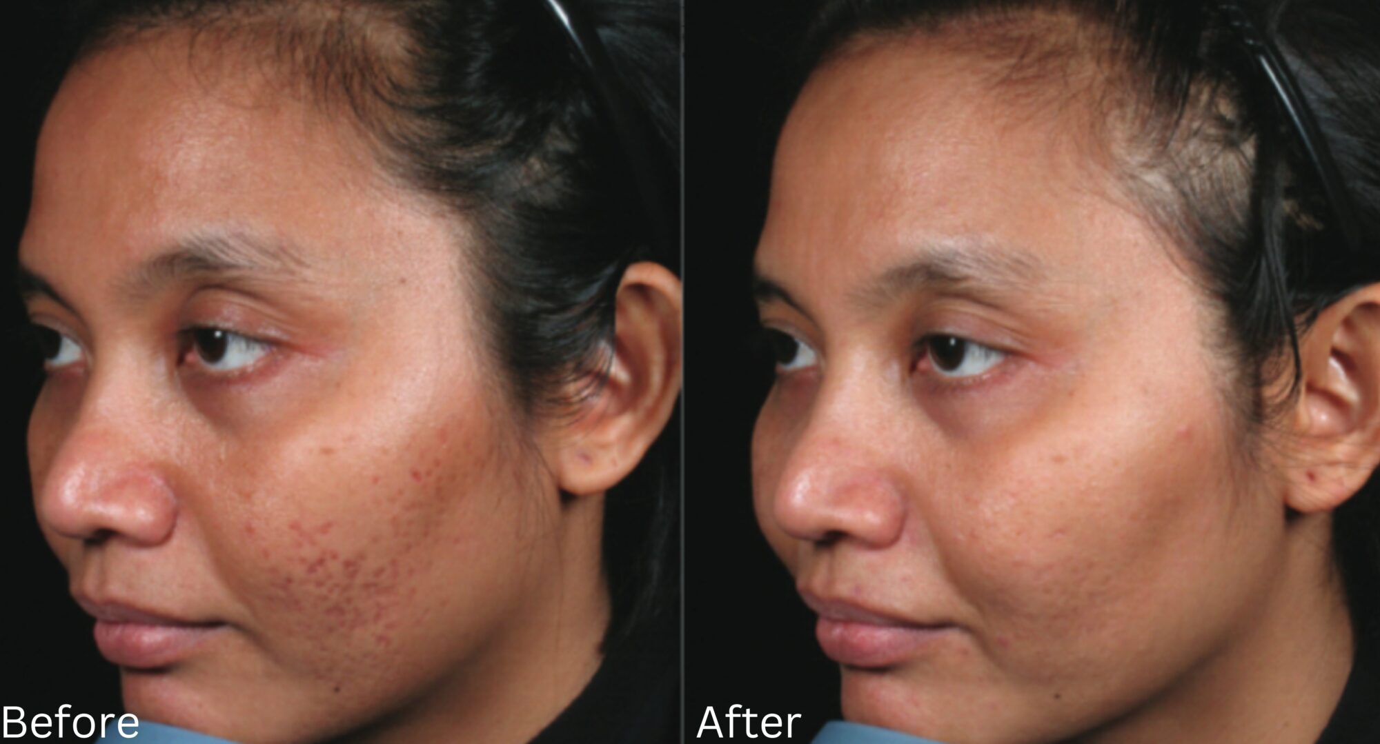 Scar Therapy - Dr. Chernoff Plastic Surgery