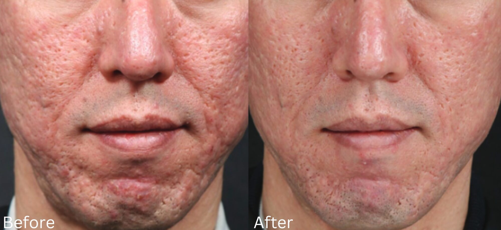 Scar Therapy - Dr. Chernoff Plastic Surgery