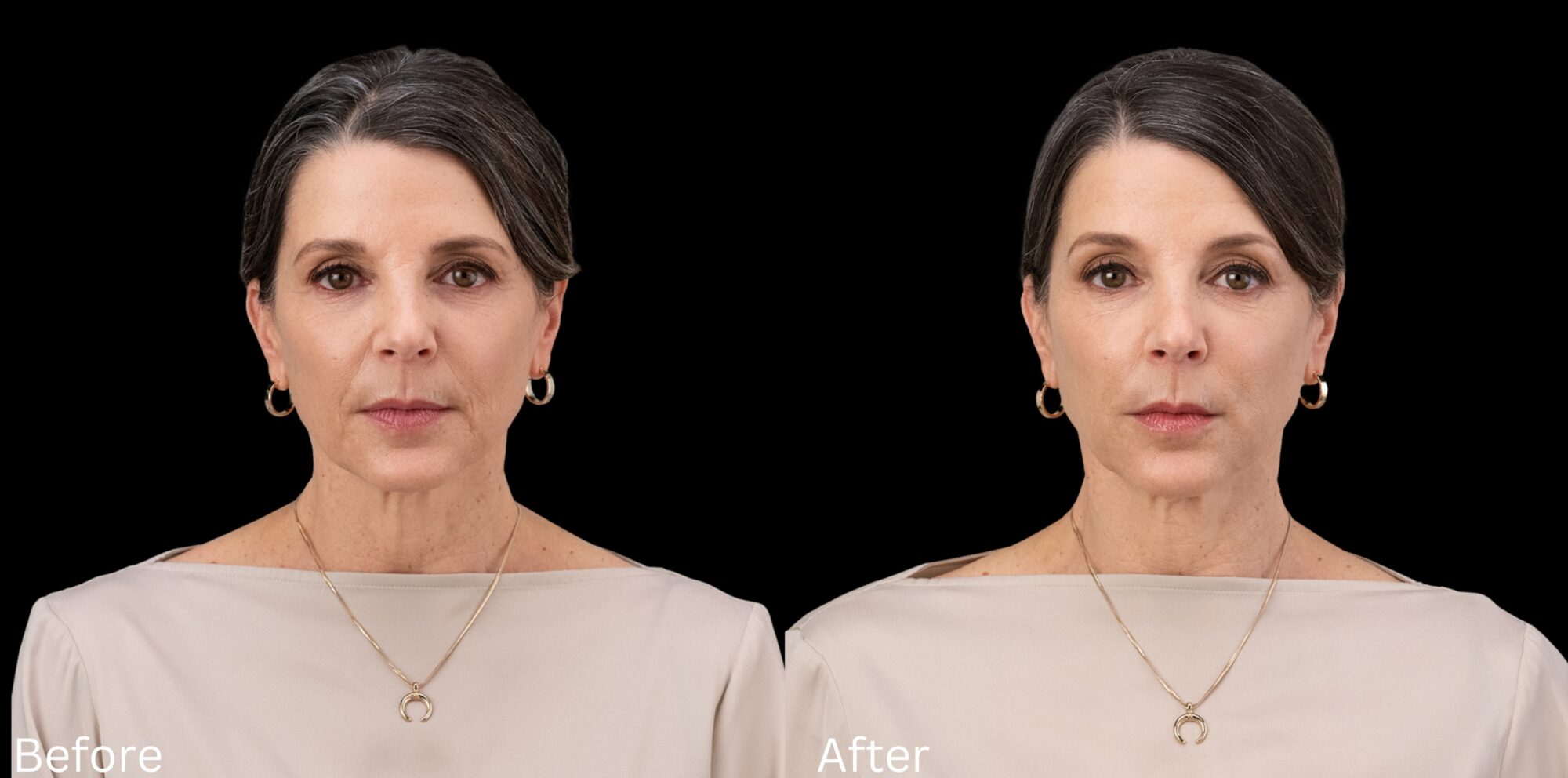 RHA Collection - Dr. Chernoff Plastic Surgery