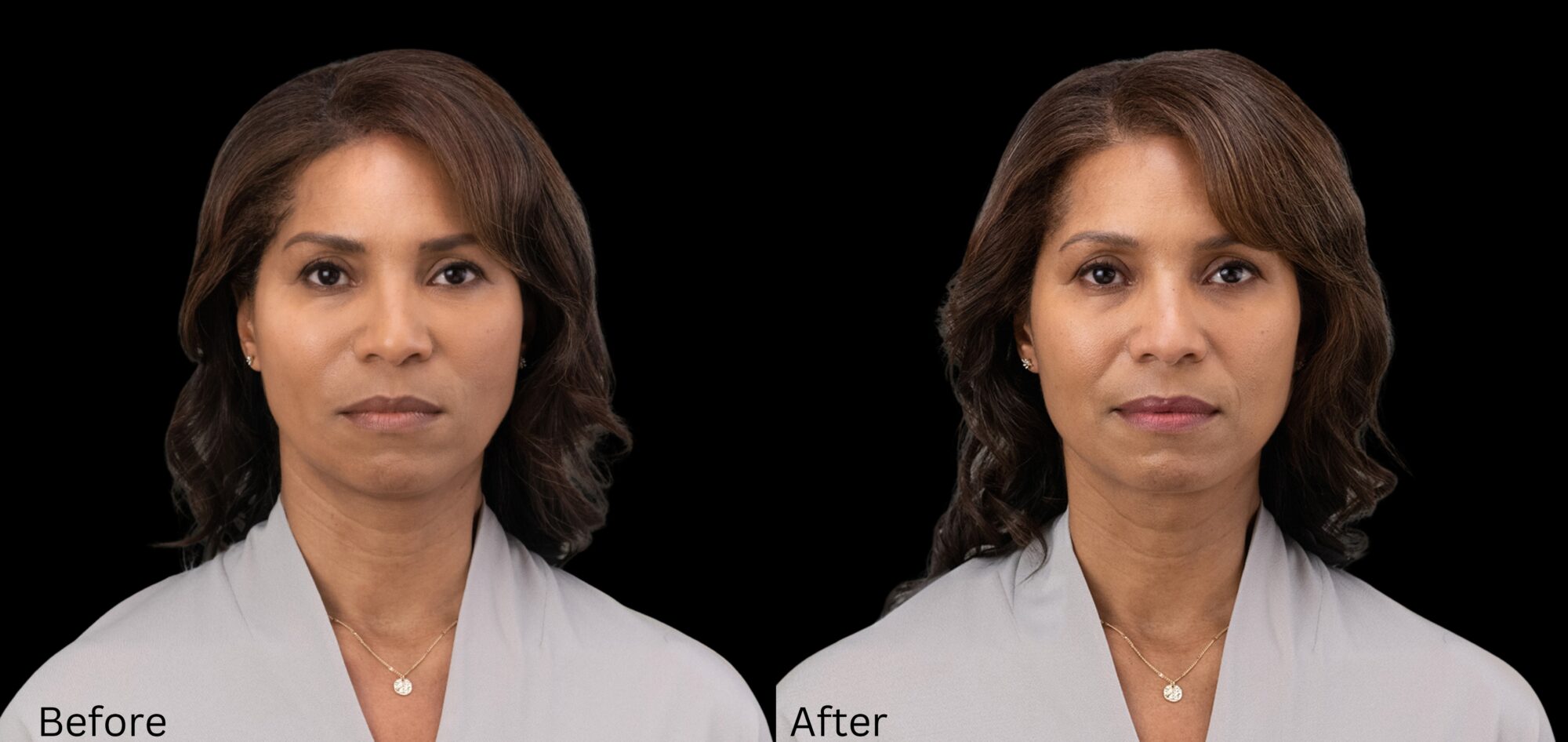 RHA Collection - Dr. Chernoff Plastic Surgery