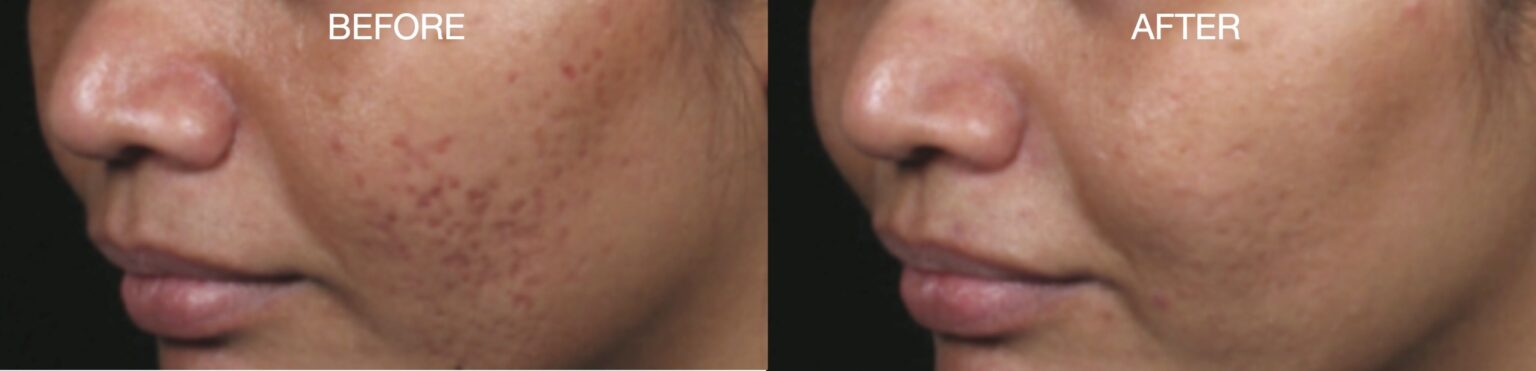 INTRAcel | Dr. Chernoff Plastic Surgery | INTRAcel Indianapolis