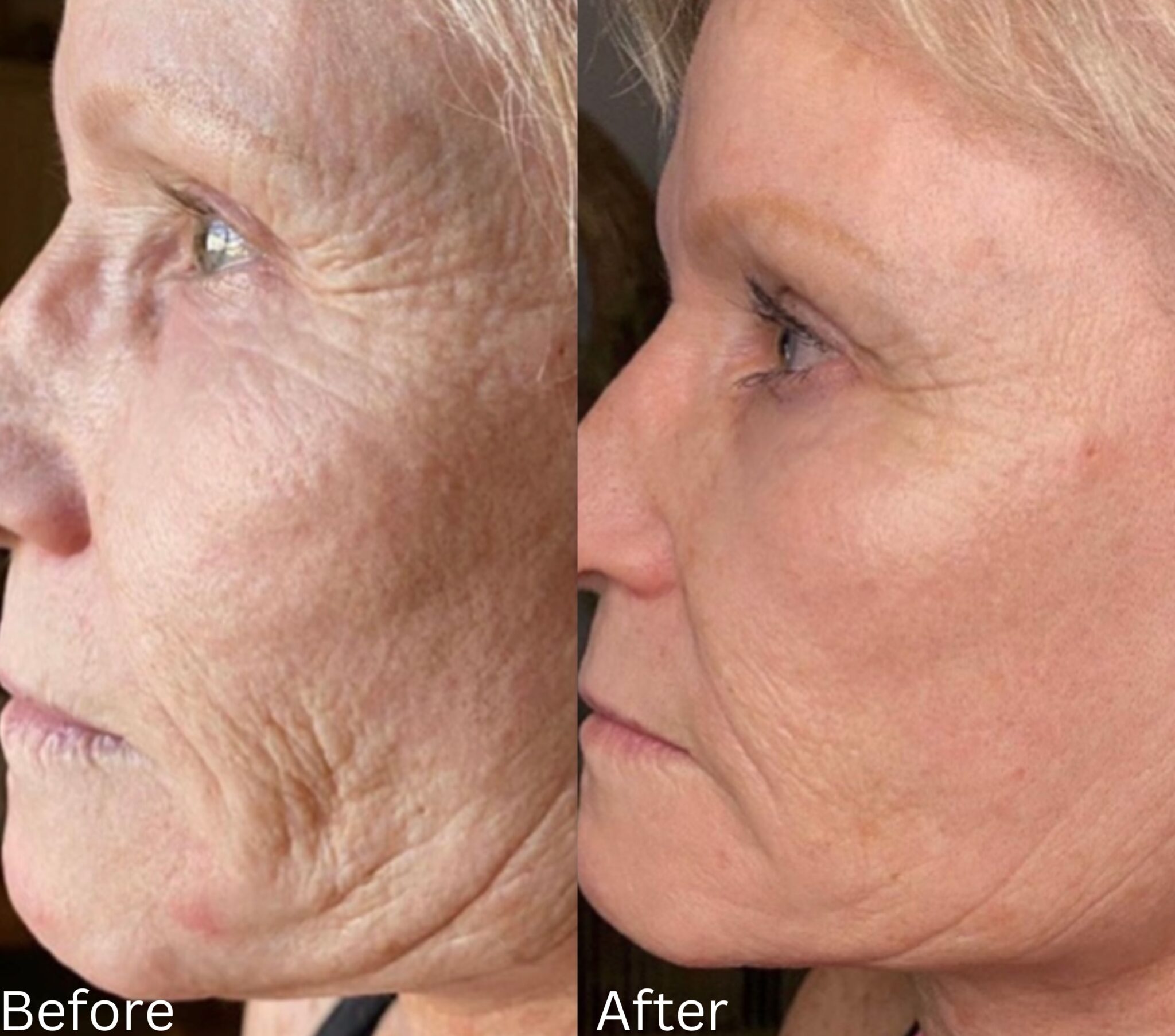 JET Plasma - Dr. Chernoff Plastic Surgery