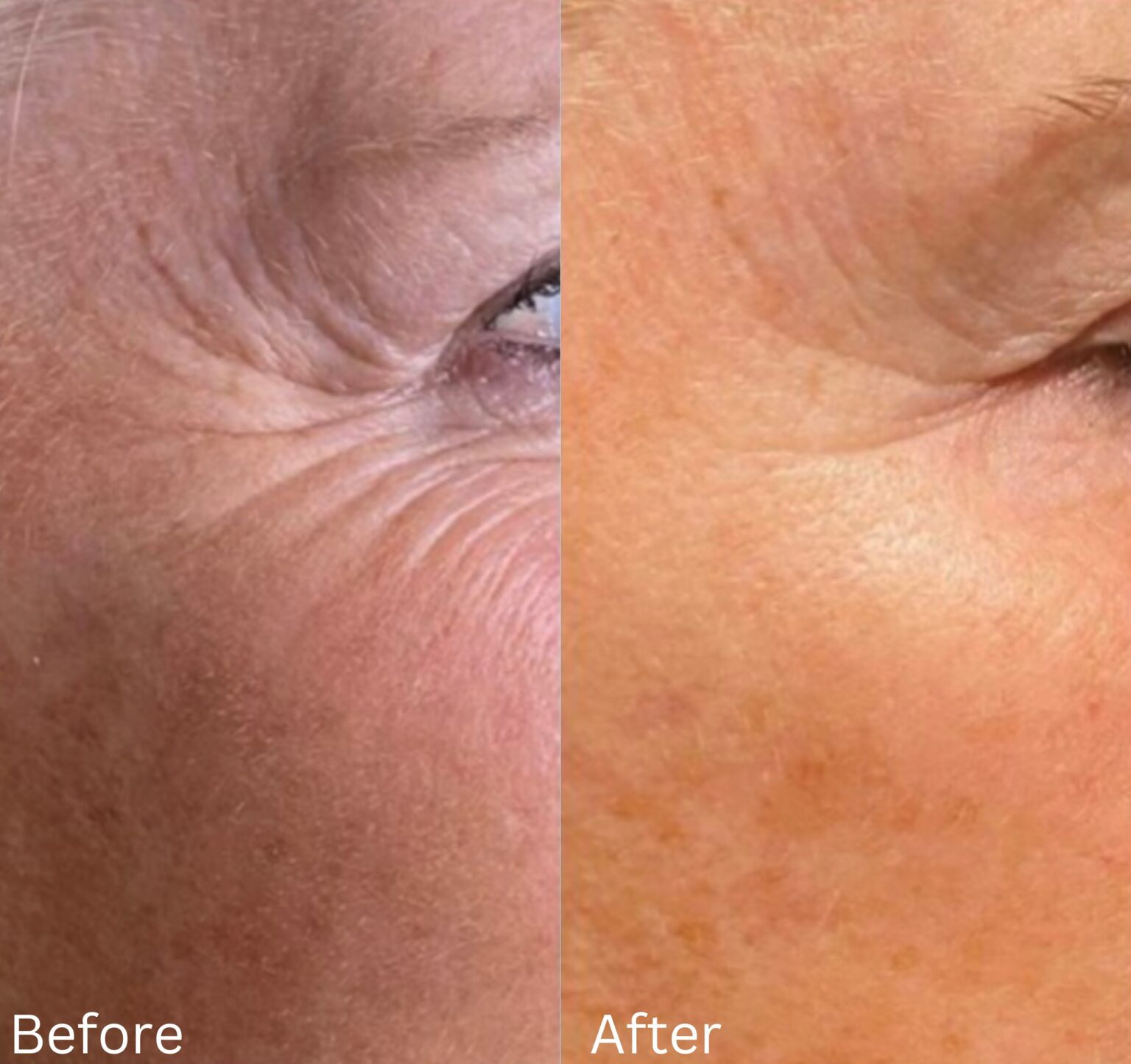 JET Plasma - Dr. Chernoff Plastic Surgery