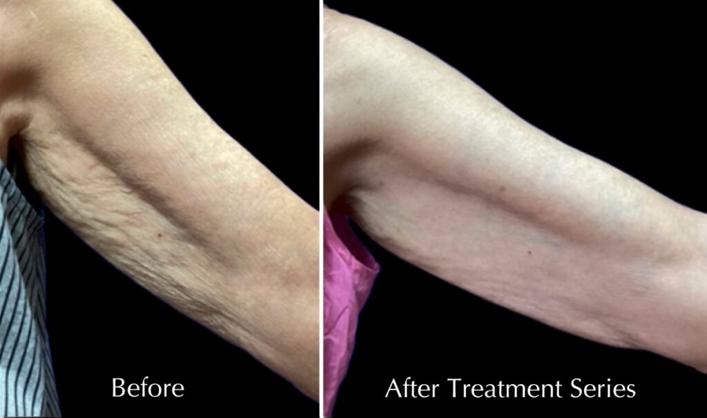 Sofwave | Dr. Chernoff Plastic Surgery | Sofwave Indianapolis