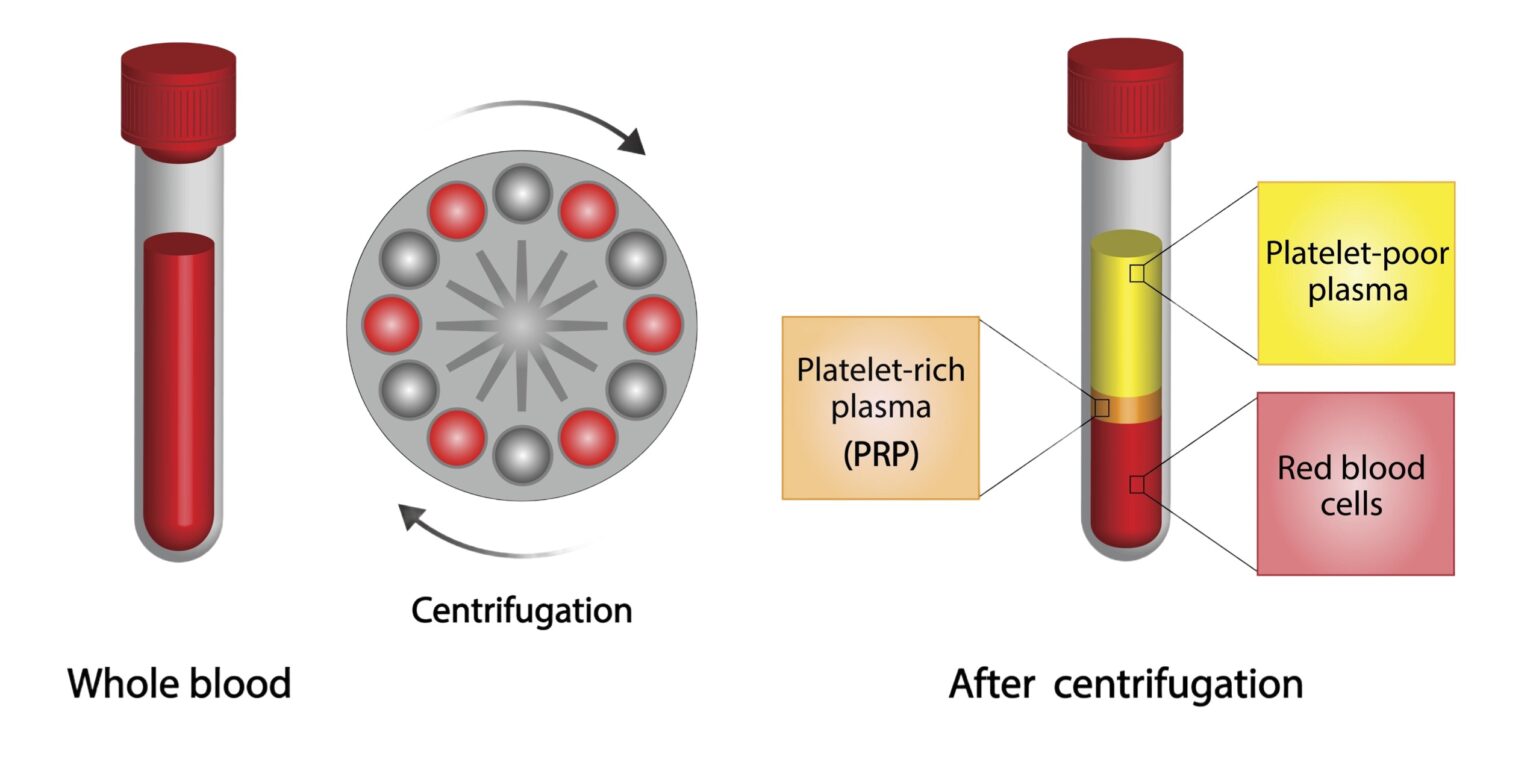 Platelet Rich Plasma | Dr. Chernoff | PRP Indianapolis
