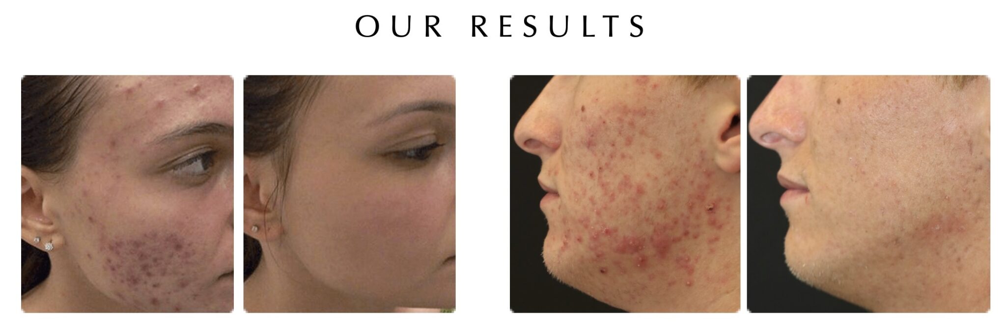 Acne Boot Camp - Dr. Chernoff Plastic Surgery - Acne Treatment
