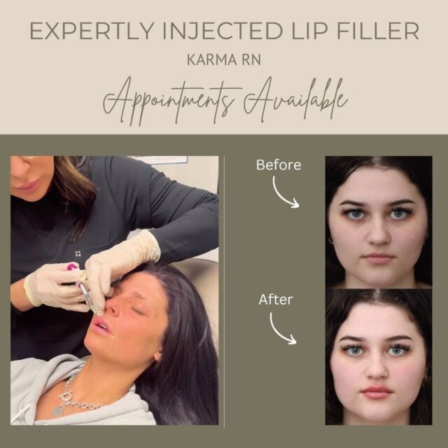 Lip Lift - Dr. Chernoff Plastic Surgery